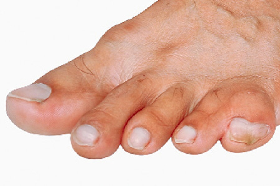 Webbed Toes Explained